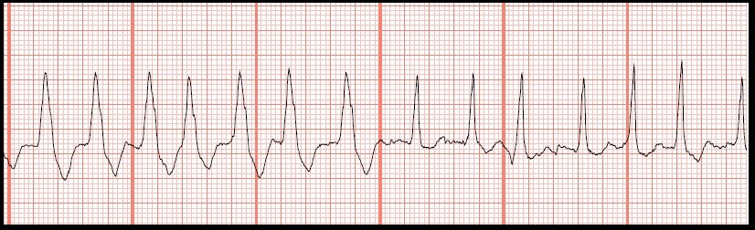 Practice EKG Rhythm Strips 103