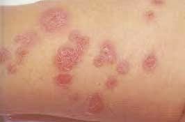 How to Prevent Impetigo | Health and Beauty tips