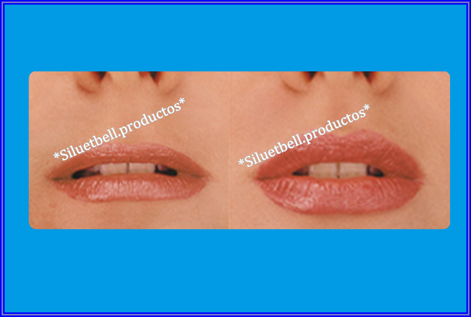 HIALURÓNICO INYECTABLE PERÚ: ÁCIDO HIALURÓNICO RETICULADO PARA RELLENO ...