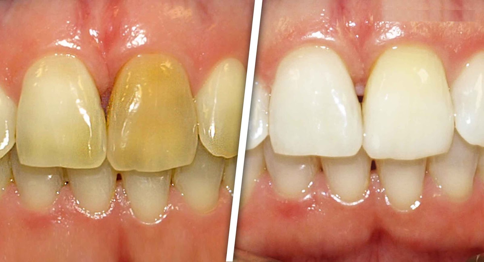 trucos caseros para eliminar el sarro de tus dientes. Quedarán blancos ...