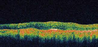 DEGENERACION MACULAR : DMAE SECA. OCT DE CONTROL