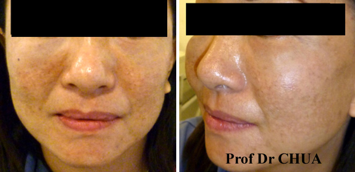 Eyelid Surgery by Prof Dr CN CHUA 蔡鐘能: Complications of Tear Trough ...