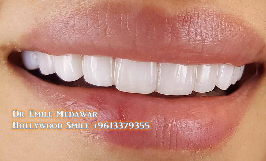 Dr Emile Medawar, Hollywood Smile, Lebanon, 00 961 3 379355: Beautiful ...