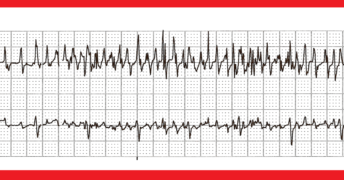 Float Nurse: EKG Rhythm Quiz 218