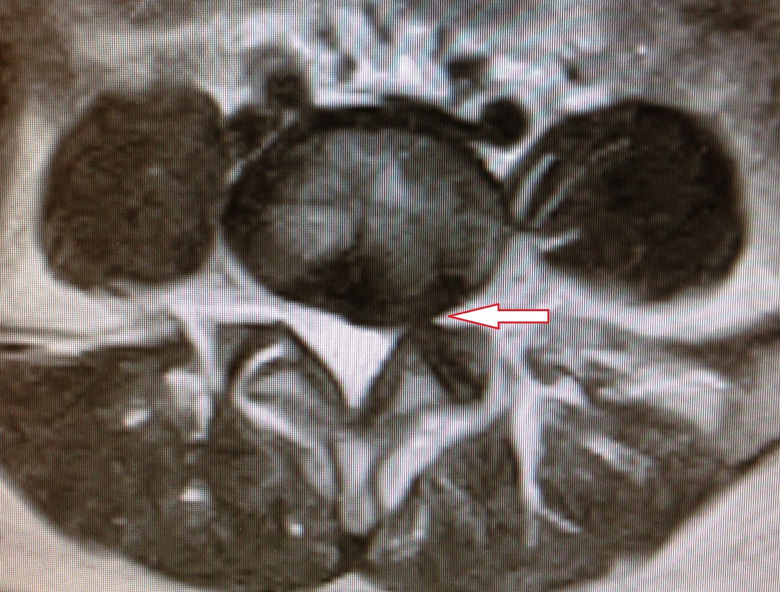 Normal Spinal Mri