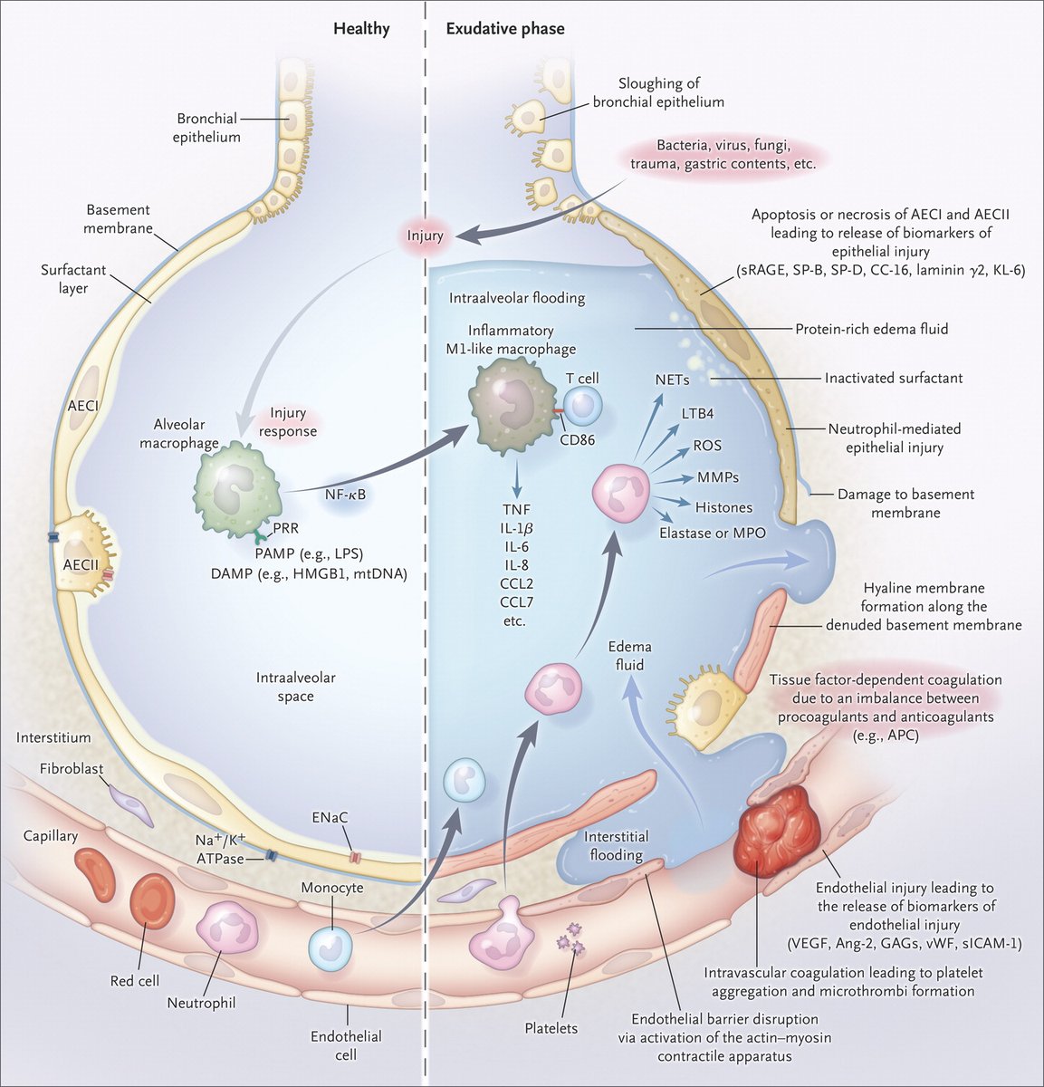 EmergenMed Health Blog: Síndrome de Dificultad Respiratoria Aguda