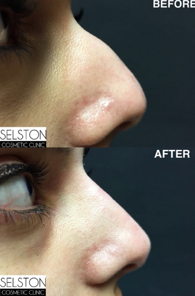 Selston Cosmetic Clinic: Transform Your Nose Shape with Non-Surgical ...