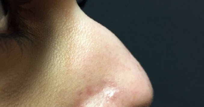 Selston Cosmetic Clinic: Transform Your Nose Shape with Non-Surgical ...