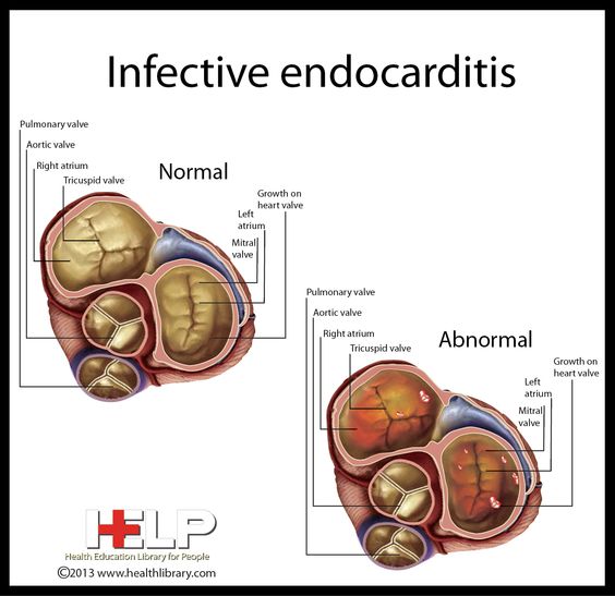 Sliced and Sutured: Tricuspid Valvectomy