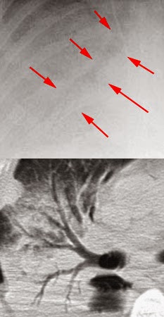 Chest Medicine Made Easy-Dr Deepu: Air Bronchogram Sign.
