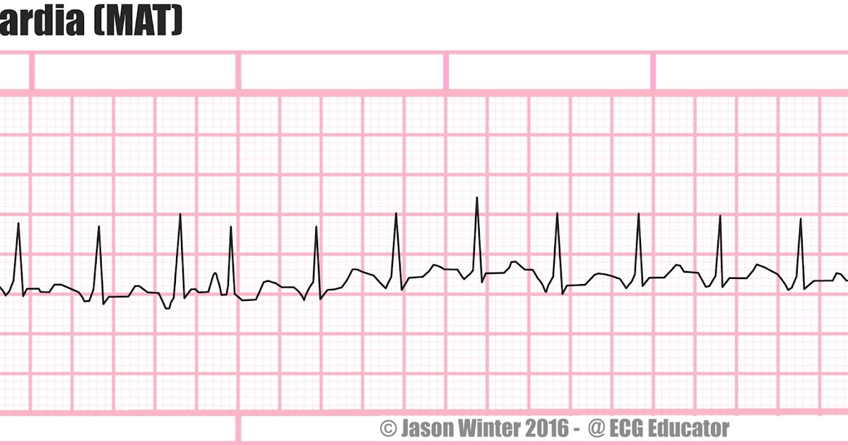 ECG Educator Blog : Multifocal Atrial Pacemaker (MAT)