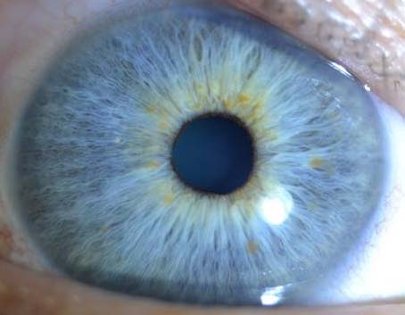 Modern & Multidimensional Iridology: Multiple Pupil Flatness, Orange ...