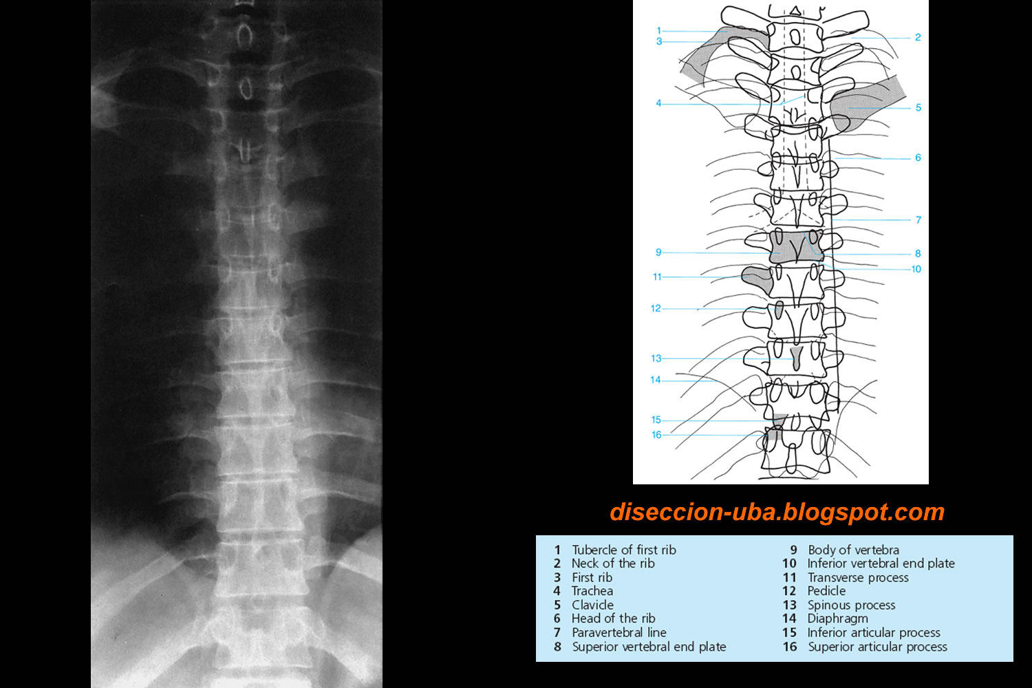 rx: Rx columna torácica anteroposterior