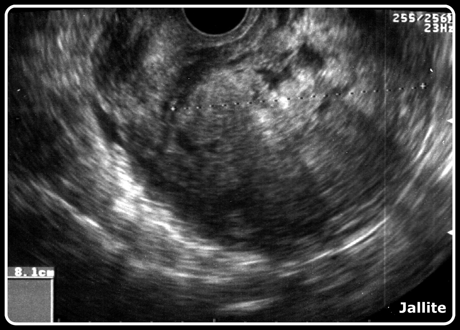 Carcinoma Endometrial