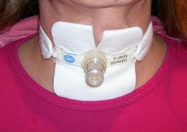My Voice: Ventilation of Neck Breathers Undergoing a Diagnostic ...