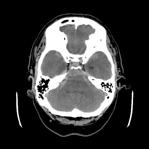 X-RAYview: Hemorragia SUBARACNOIDEA