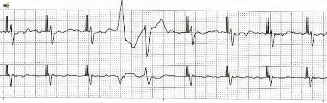 Practice ECG Rhythm Strips 133