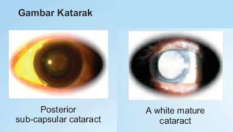 Leaflet Katarak | DUNIA KEPERAWATAN