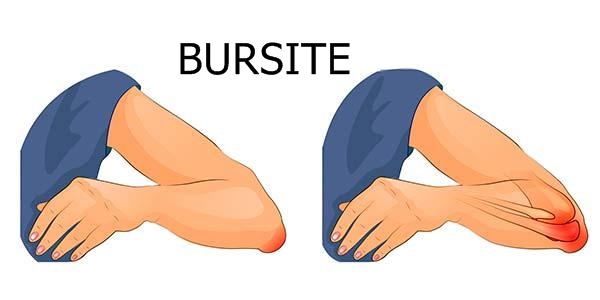 BURSITE EM DIFERENTES PARTES DO CORPO. CAUSAS E TRATAMENTOS