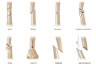 Norman K. Poppen MD: Buckle and stress: The different types of fracture