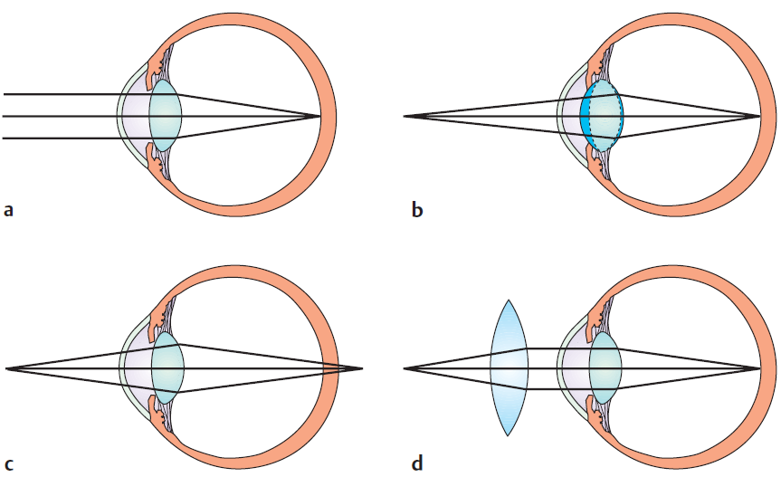 necesidad de acomodación