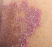 Pengobatan Untuk Eksim Kering | Obat Herbal Murah