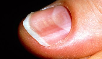 Dicas de Enfermagem: Relação das unhas e saúde geral