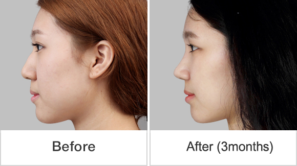 [Real Story] Through Korean Celebrities Rhinoplasty, My Nose Became ...