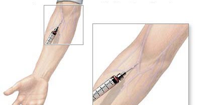 AMG: FIȘE- TEHNICI DE NURSING - 6 : Injecţia intravenoasă