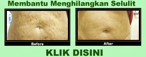 Penghilang Selulit: Penyebab Gejala Selulit