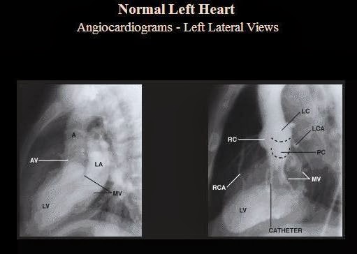 Melihat Jantung pada Proyeksi Rontgen (Bagian II: Angiocardiogram)
