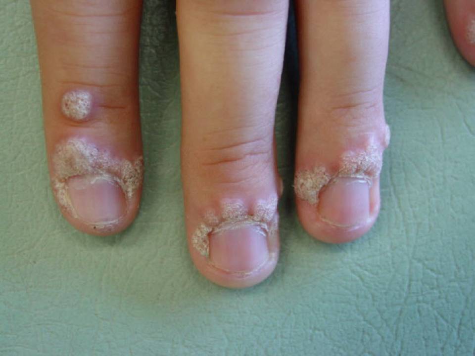 Consultations in Dermatology: The Persistent Invaders- Warts