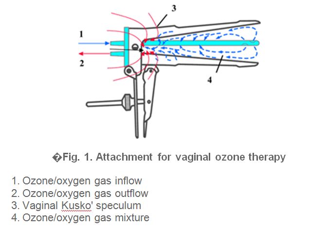OZONE THERAPY: - OZONE: OBSTETRICS & GYNAECOLOGY