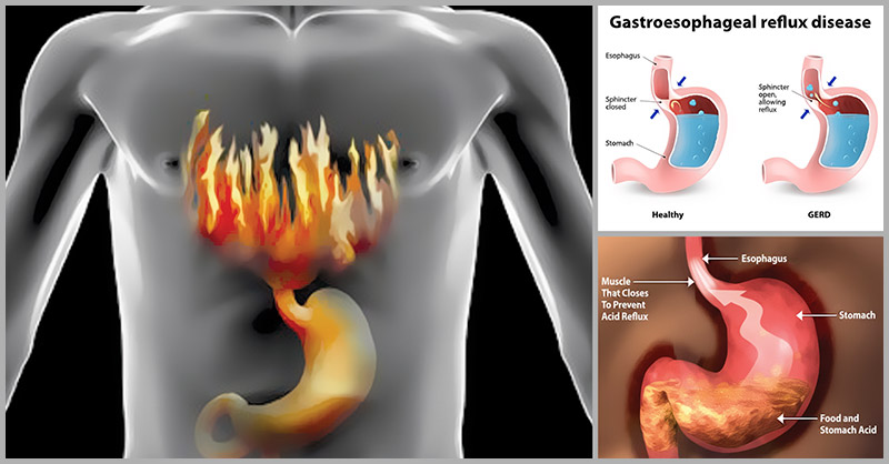 Reasons Why We Shouldn’t Ignore Heartburn - Dr. Farrah MD Reasons Why We Shouldn’t Ignore Heartburn - Dr. Farrah MD