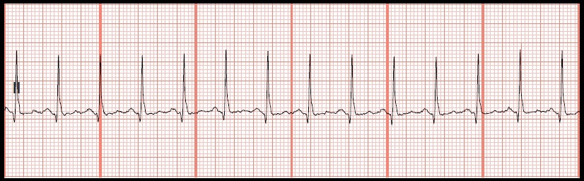 Practice ECG Rhythm Strip 108