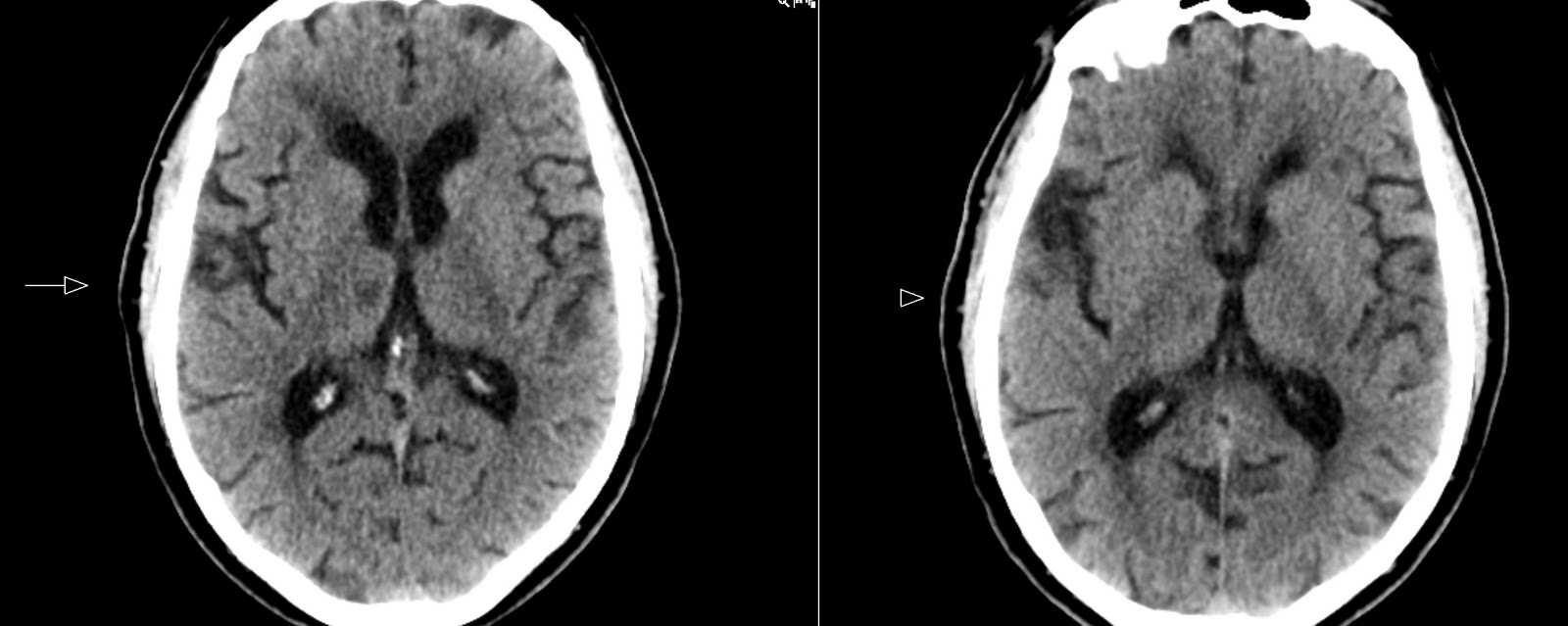Radiology Mri Thalamic Infarct