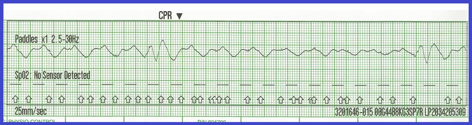 Code Blue: Sudden Cardiac Arrest