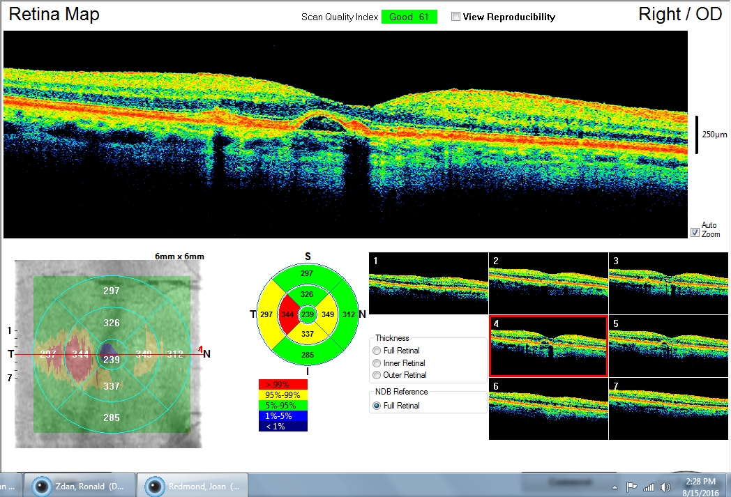 Sonoran Desert Eye Center: RPE DETACHMENT