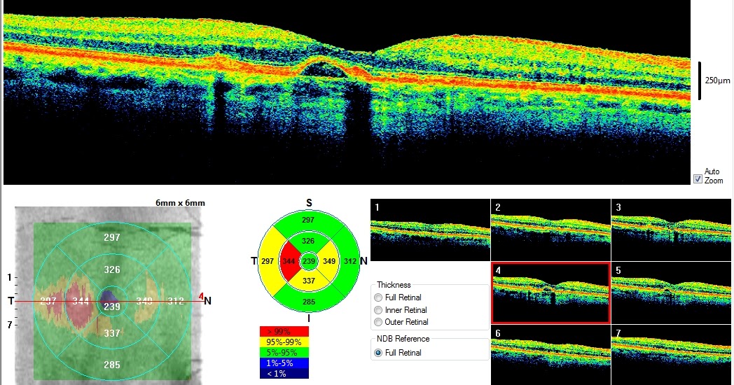 Sonoran Desert Eye Center: RPE DETACHMENT