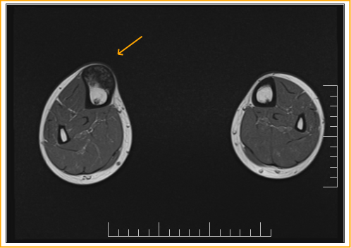 Adamantinoma Tibia -Cross sectional Imaging - Sumer's Radiology Blog