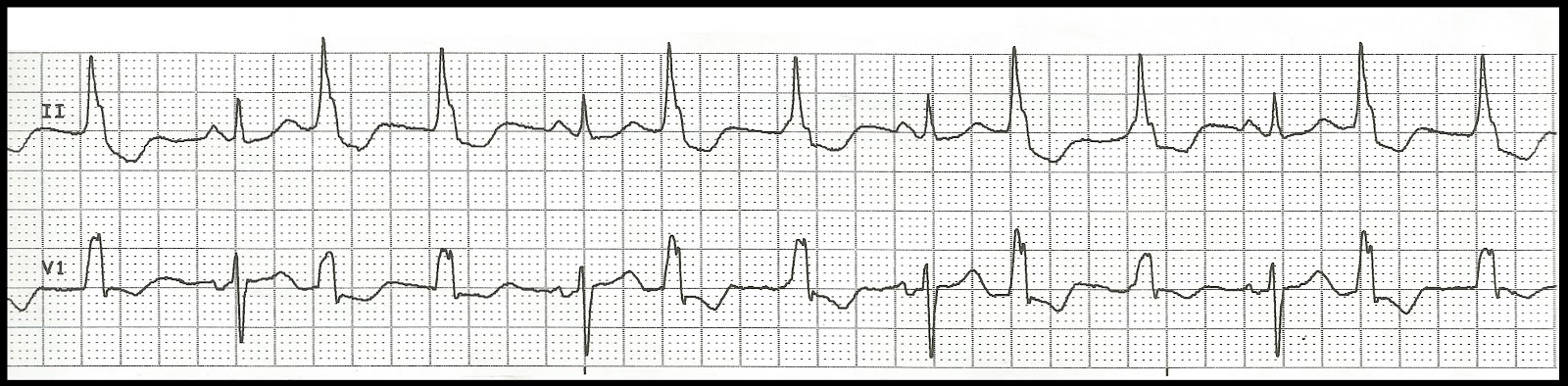 Practice EKG Rhythm Strips 174