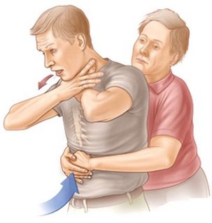 ATRAGANTAMIENTO (OVACE - OBSTRUCCIÓN DE VÍA AÉREA POR CUERPO EXTRAÑO ...