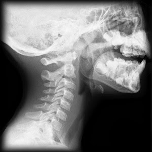 UPPER AIRWAY X-RAY | LATERAL PROJECTION - RadTechOnDuty