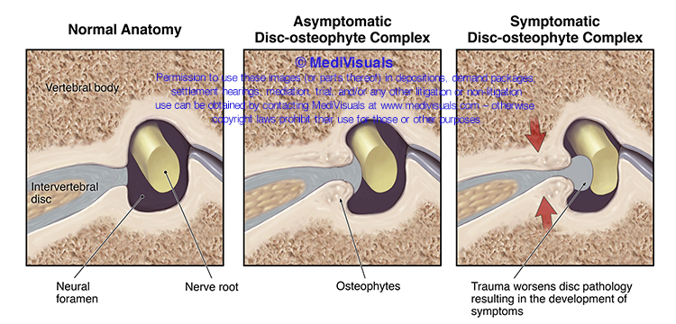 The Medical Legal Exhibit Expert Blog: Disc-Osteophyte Complex Explained
