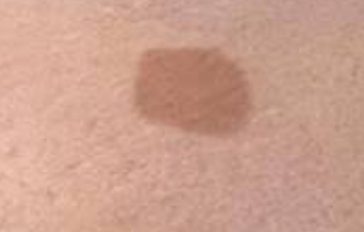 Skin Health; Understanding Skin Lesions