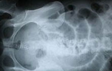 Paralytic ileus - Medical Education