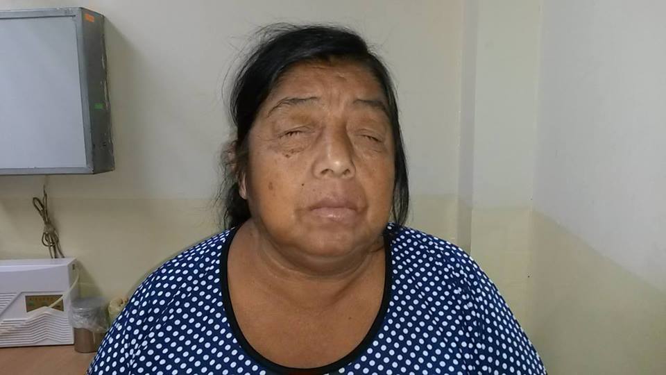 EL RINCÓN DE LA MEDICINA INTERNA. juanpedromacaluso@yahoo.com.ar: MIXEDEMA