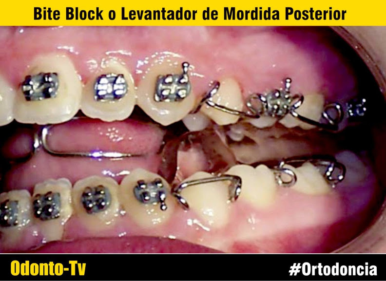 BITE BLOCK o Levantador de Mordida Posterior - Rampal