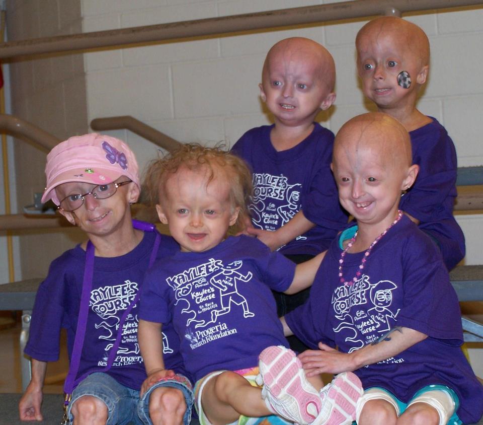 .: Conheça algumas Crianças Com Progeria