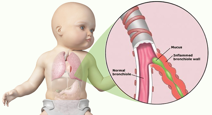 Pediatrics Notes: Clinical Manifestations of Bronchiolitis